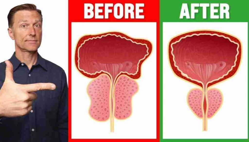 The Number 1 Important Nutrient to Shrink the Prostate Gland - Marcelo ...